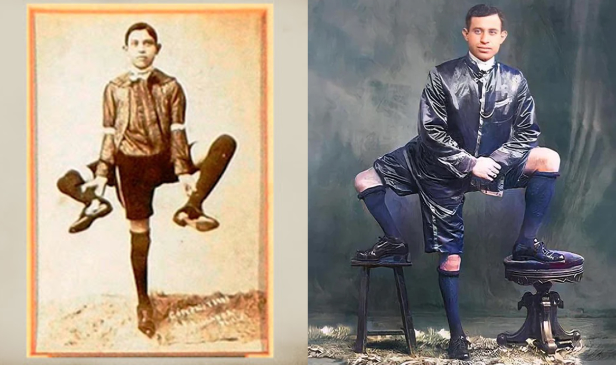 The Extraordinary Life Of The Three-Legged Man