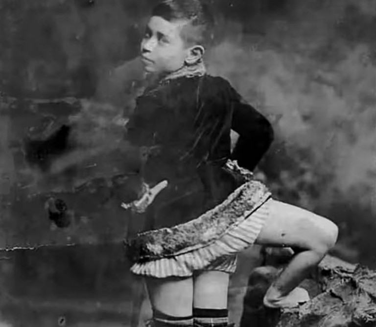 The Extraordinary Life Of The Three-Legged Man